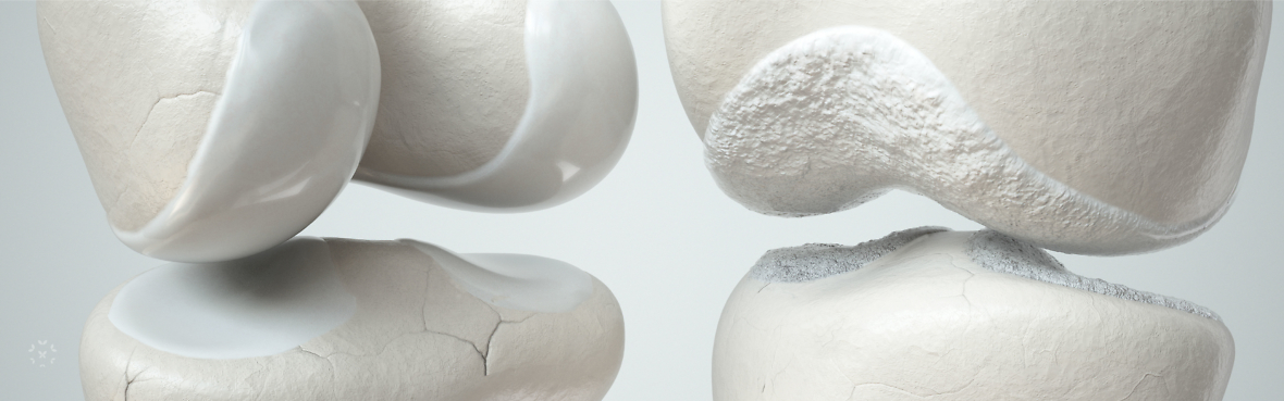 Mixed Connective Tissue Disease (MCTD) and Lupus - Kaleidoscope ...